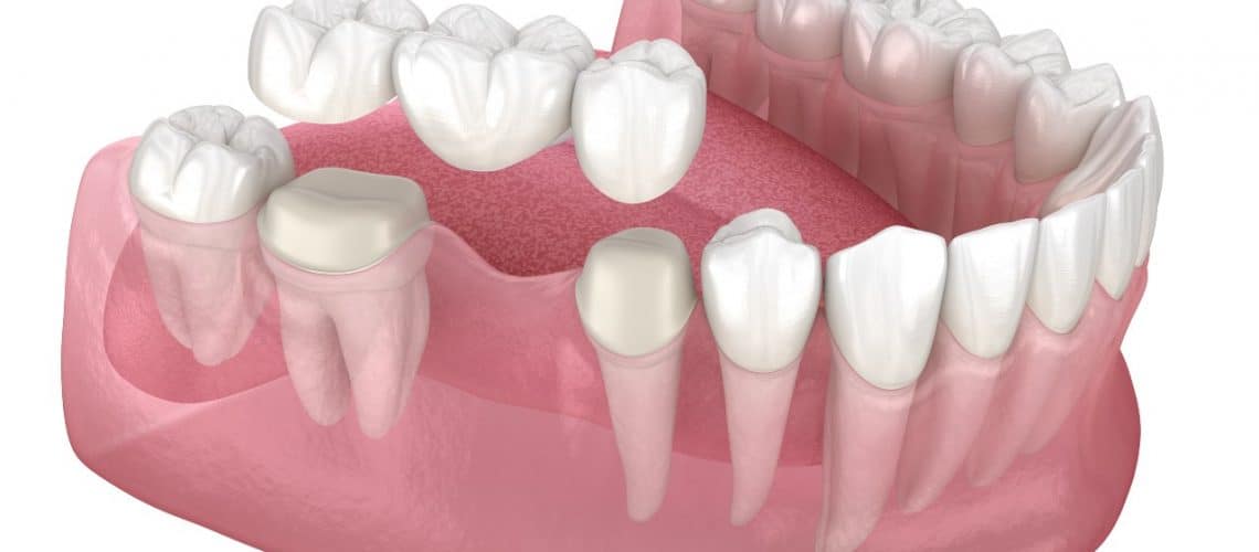 What Does Gum Pain Around a Dental Bridge Suggest? - Today's Dental